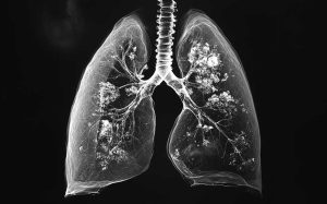 10 Common Types of Asbestosis Symptoms